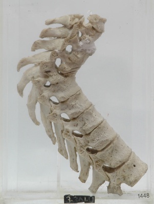Tuberculosis, Pott's spine; skeletal; 1448 | eHive