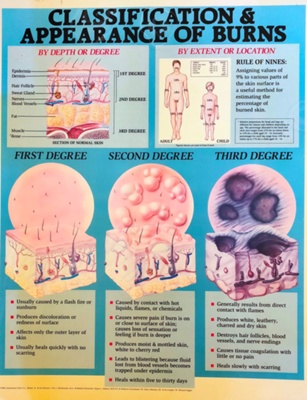 Poster: Classification and Appearance of Burns; Anatomical Chart Co ...