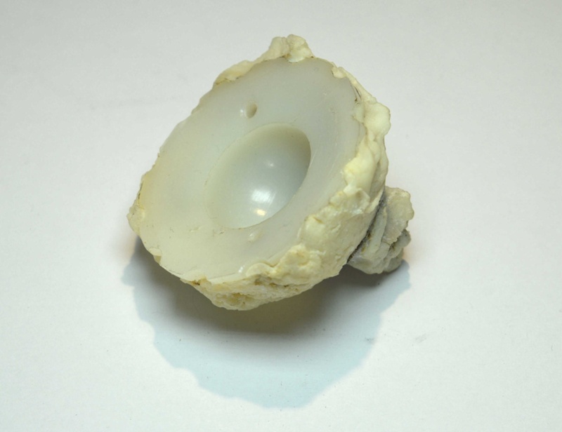 Femoral Head Hip Replacement Prosthesis; J.R.I ?; 1950s; 2007.023RCS ...